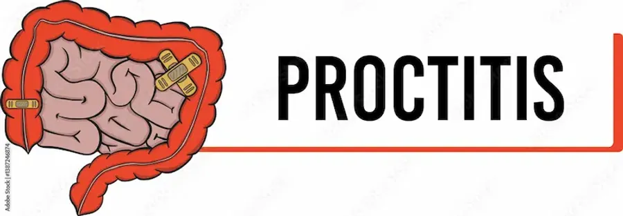 Proctitis Overview of Symptoms and Treatments